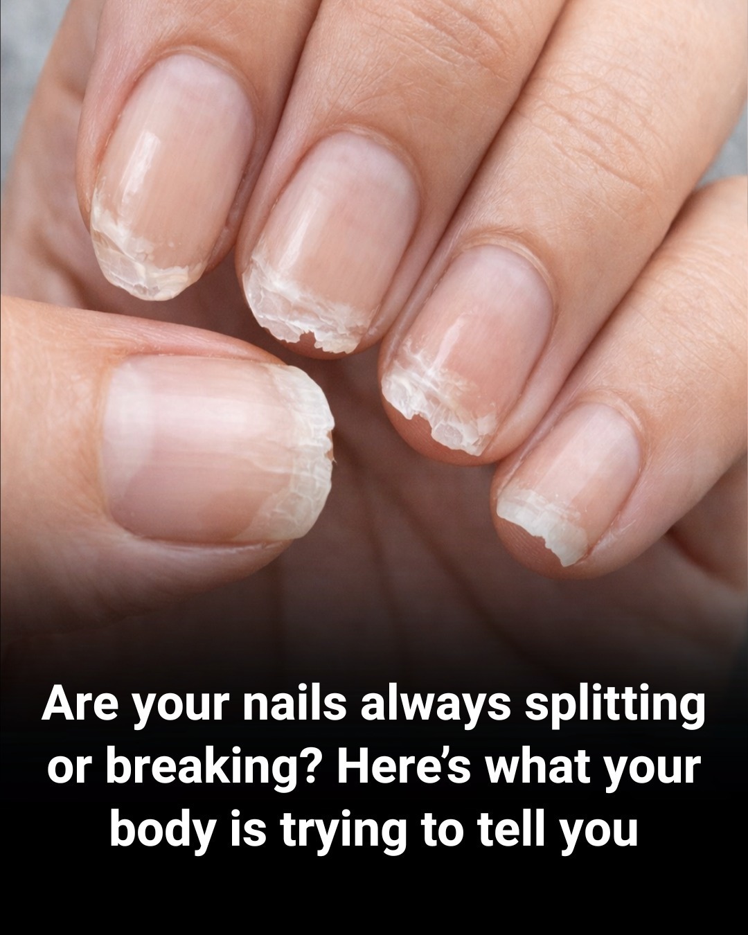 Weak or Brittle Nails: What Your Body Is Trying to Tell You – Best Recipes