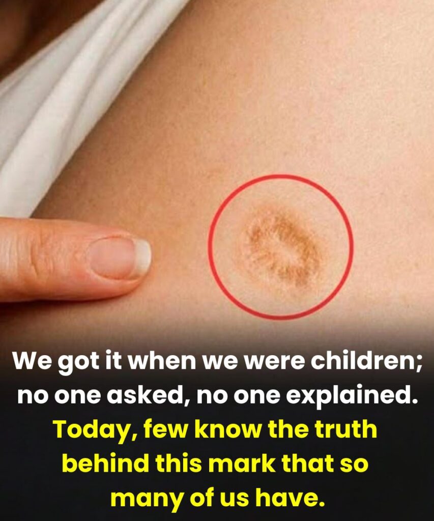 5 Common Misconceptions About the Round Scar on the Upper Arm – Best ...